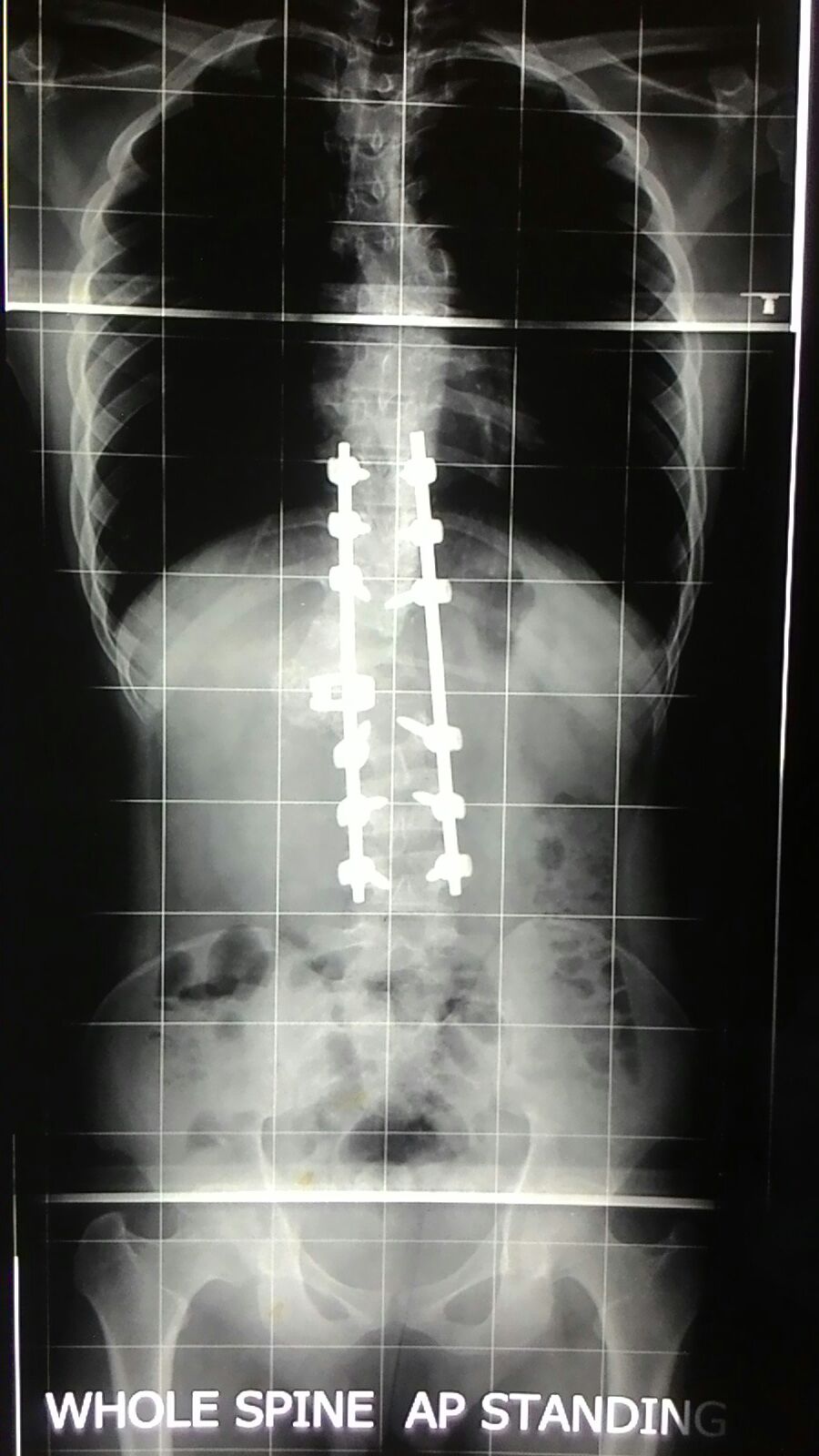 Case Study: Congenital Spinal Deformity – Jeffrey R McConnell, M.D.